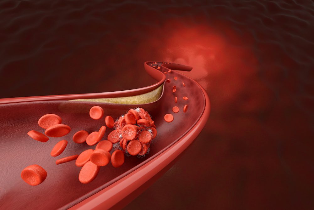 Blood Clots: Why They’re Dangerous and What to Watch For - Eileen ...